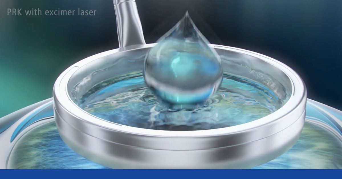 การผ่าตัดแบบ PRK